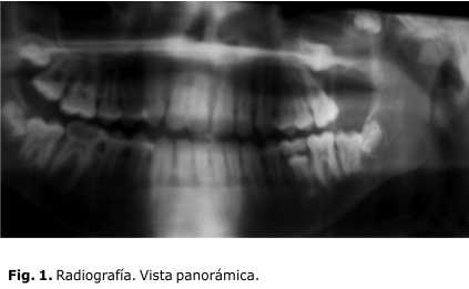 Segundo y tercer molar en seno maxilar | Almunia Quesada | Revista ...