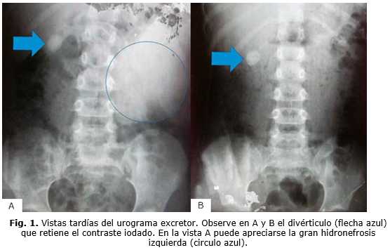 Divertículo calicial y su diagnóstico inicial | Durán Álvarez | Revista ...